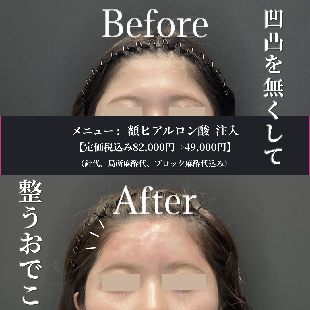 額ヒアルロン酸 注入 | 症例写真 | Credo Clinic
