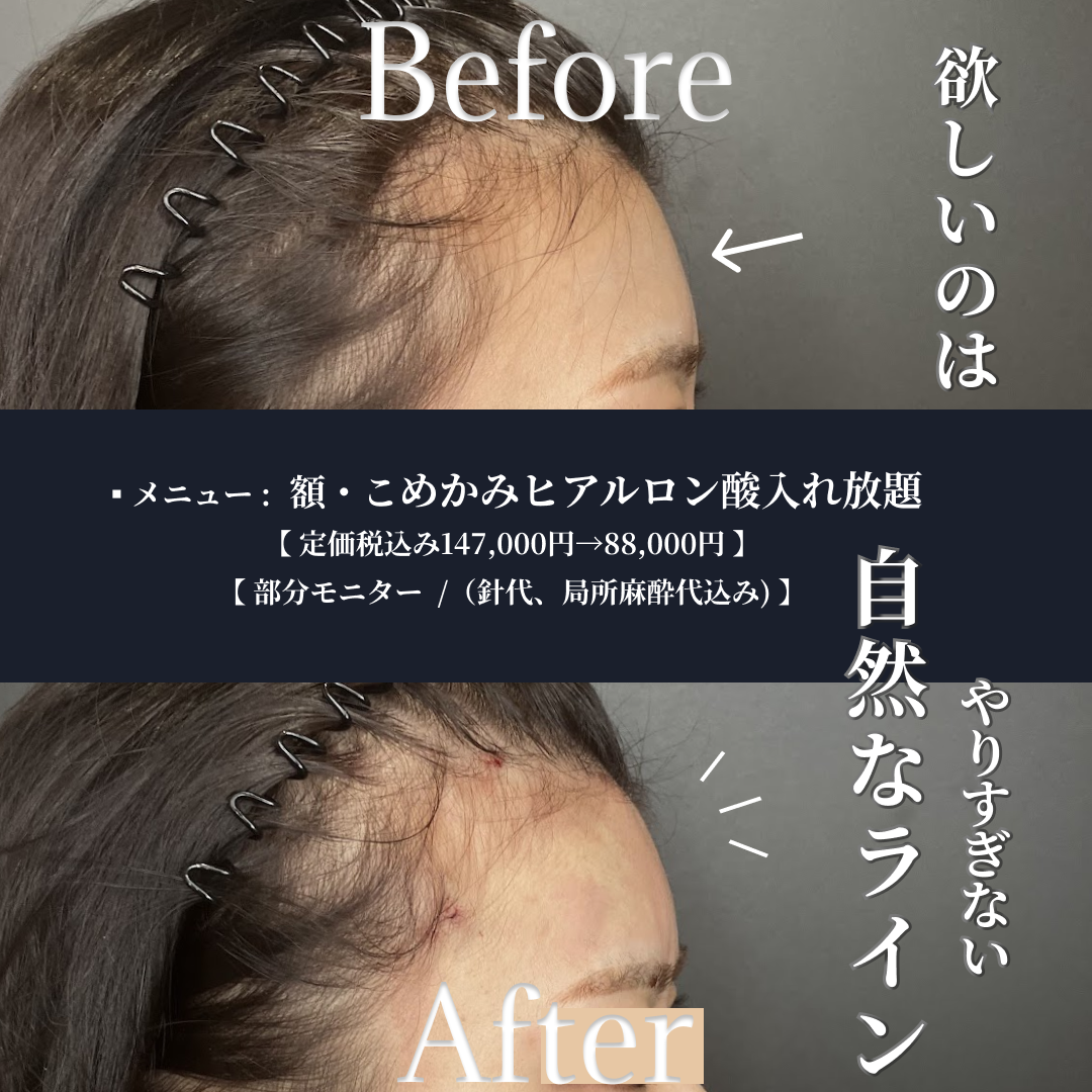 額・こめかみヒアルロン酸 | 症例写真 | Credo Clinic